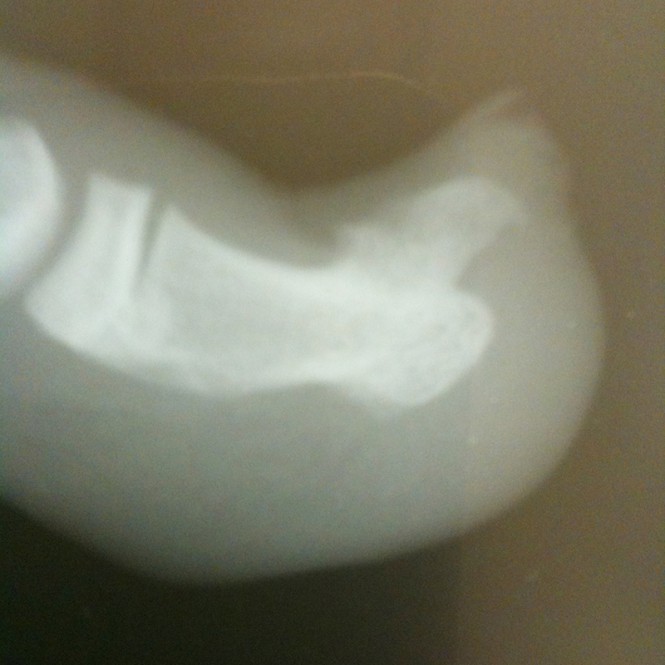 Lumps and bumps on your feet? | Yorkshire Foot HospitalYorkshire Foot ...